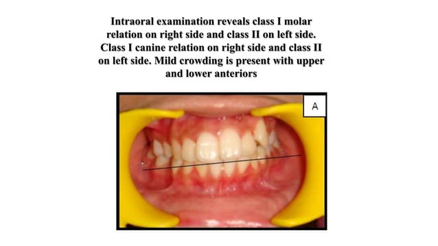 ORTHODONTIC CORRECTION OF OCCLUSAL PLANE CANTING | PPTX | Dental Health ...