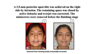 ORTHODONTIC CORRECTION OF OCCLUSAL PLANE CANTING | PPTX