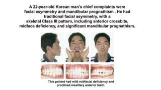 ORTHODONTIC CORRECTION OF OCCLUSAL PLANE CANTING | PPTX