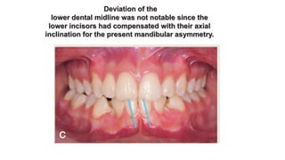 ORTHODONTIC CORRECTION OF OCCLUSAL PLANE CANTING | PPTX