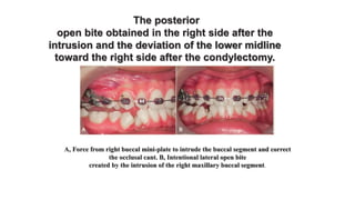 ORTHODONTIC CORRECTION OF OCCLUSAL PLANE CANTING | PPTX