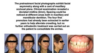 ORTHODONTIC CORRECTION OF OCCLUSAL PLANE CANTING | PPTX