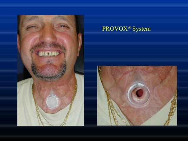 Trachéotomie et trachéostomie (Indications, prise en charge des patie…