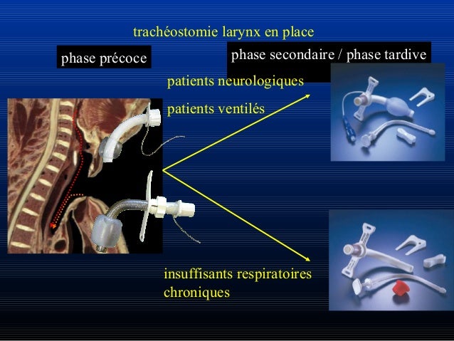 Trachéotomie et trachéostomie (Indications, prise en charge des patie…