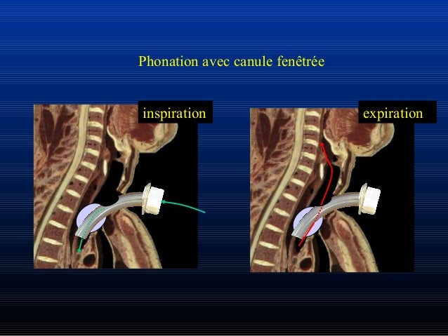 Trachéotomie et trachéostomie (Indications, prise en charge des patie…