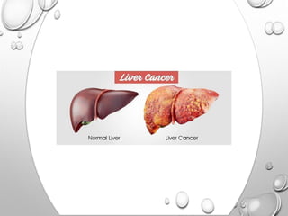 Cancer of liver - Easy ppt for Student Nurses | PDF