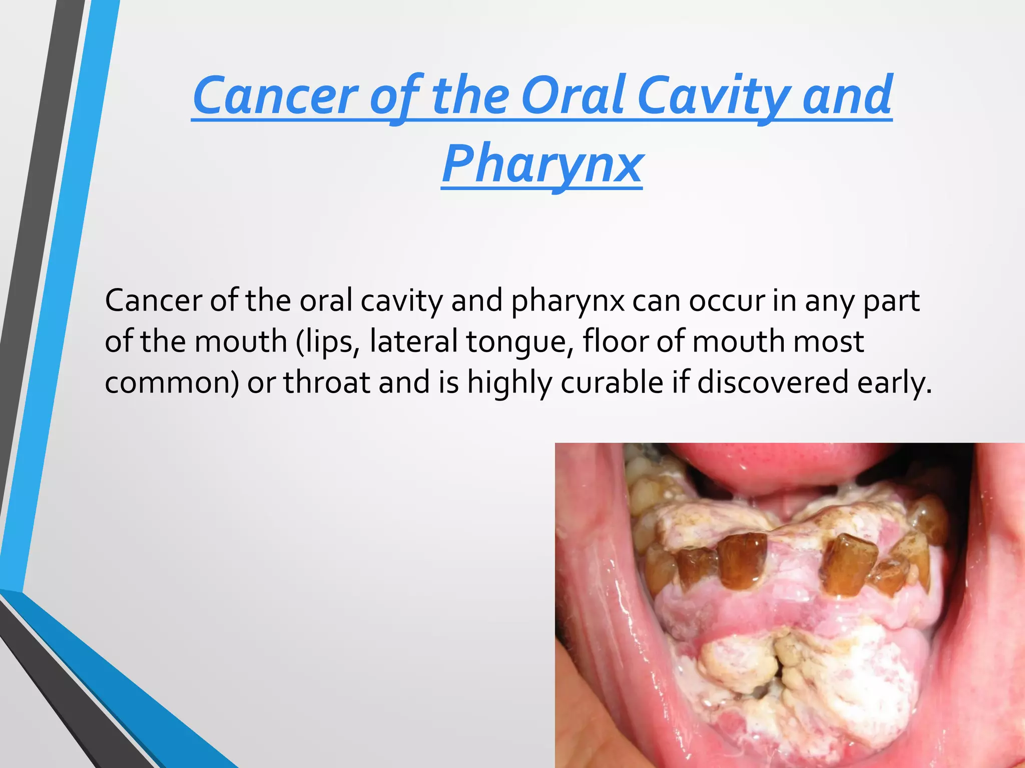 Cancer of oral cavity- Easy explanation for Nurses- | PDF