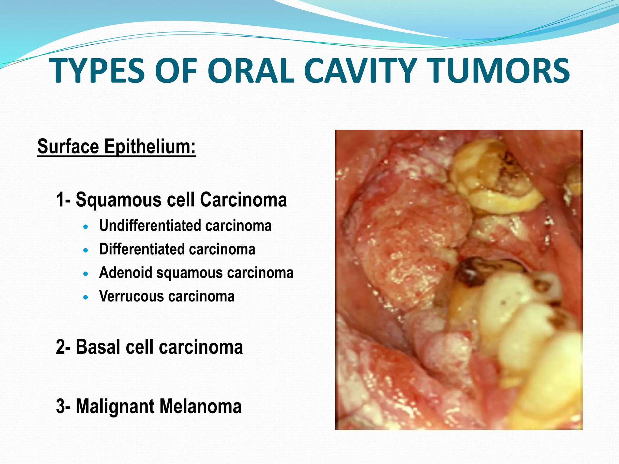 CARCINOMA OF THE ORAL CAVITY. Diagnosis and management.t | PPTX