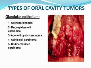 CARCINOMA OF THE ORAL CAVITY. Diagnosis and management.t | PPTX