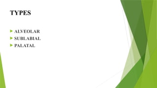 carcinoma oropharynx and oroantral fistula PowerPoint presentation | PPT