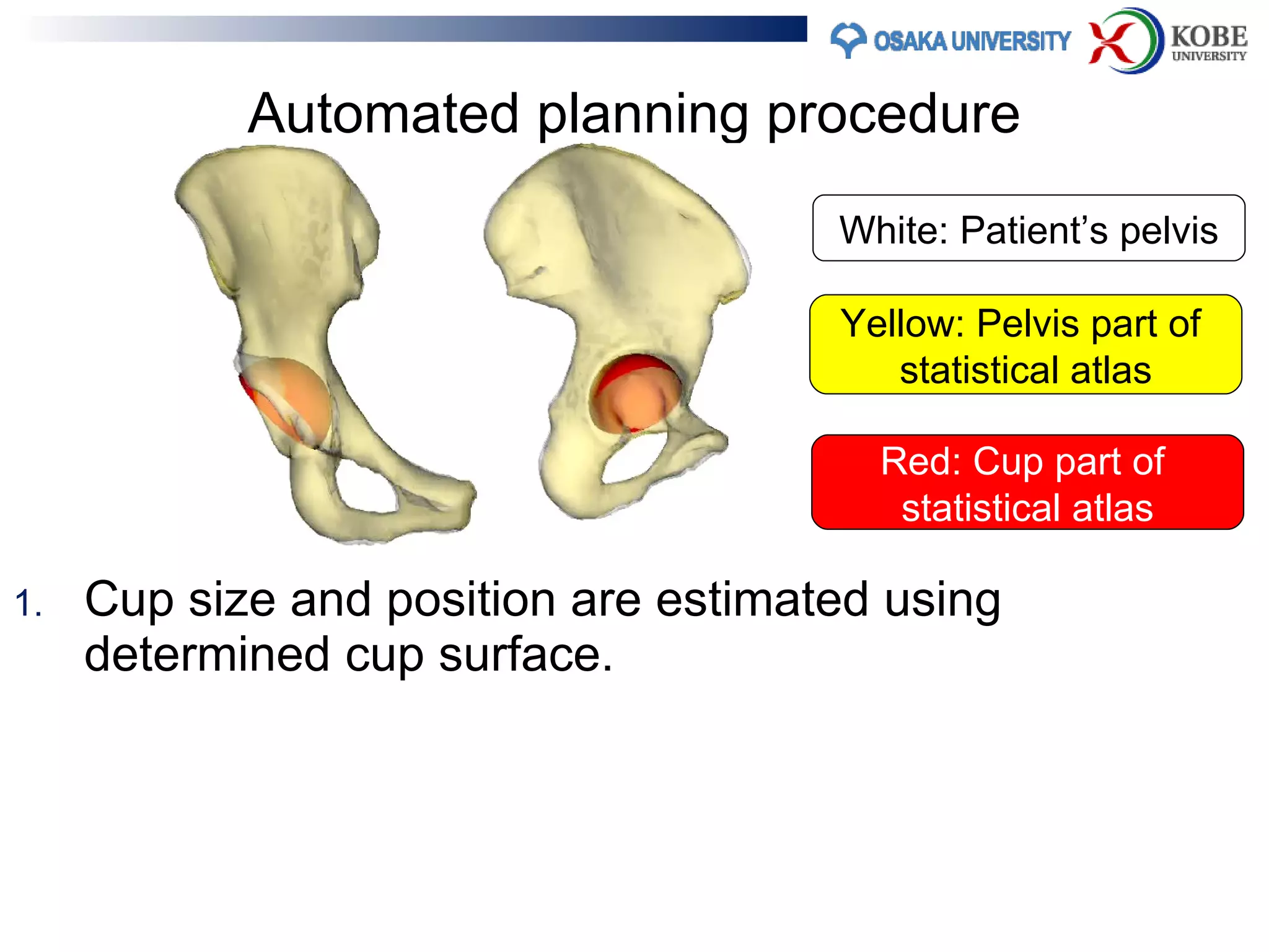 Ct Based Automated Preoperative Planning Of Acetabular Cup Size And Position Using Pelvis Cup