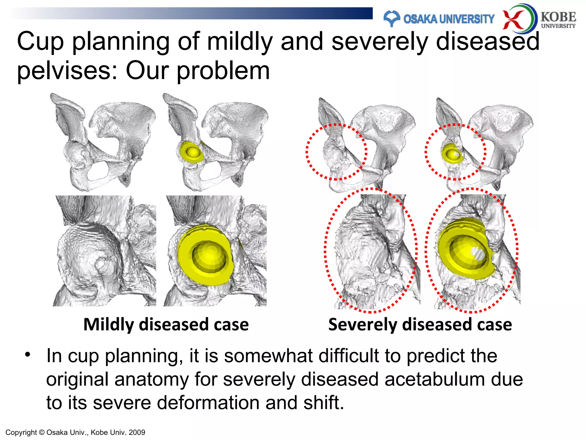 CT-based Automated Preoperative Planning of Acetabular Cup Size and ...