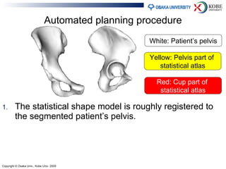 CT-based Automated Preoperative Planning of Acetabular Cup Size and Position using Pelvis-cup ...