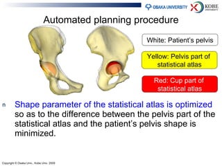 CT-based Automated Preoperative Planning of Acetabular Cup Size and Position using Pelvis-cup ...