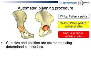 CT-based Automated Preoperative Planning of Acetabular Cup Size and ...