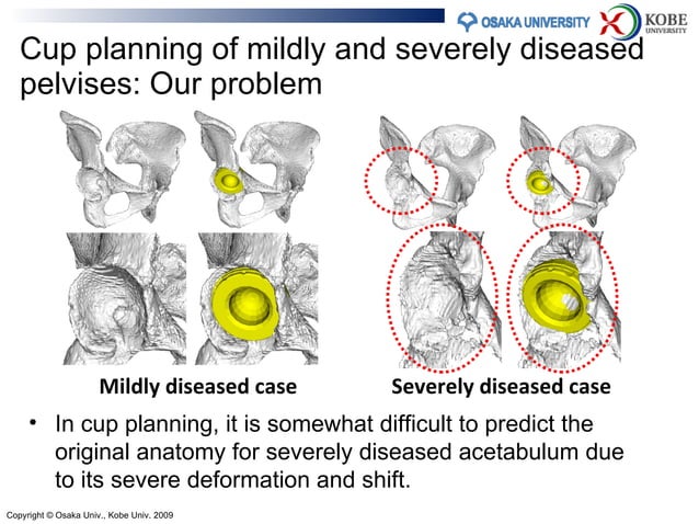 CT-based Automated Preoperative Planning of Acetabular Cup Size and ...
