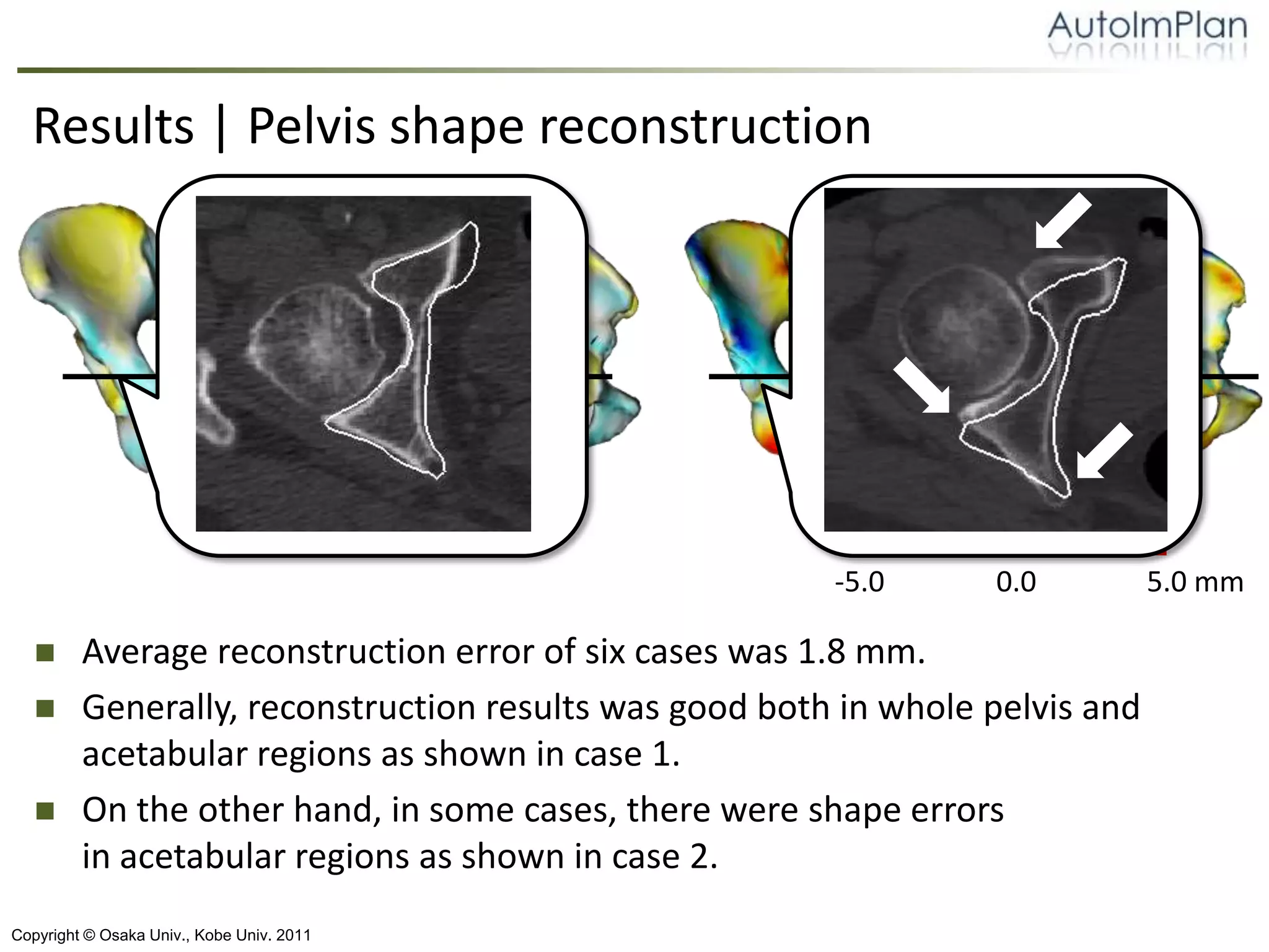 An automated 3D cup planning in total hip arthroplasty from a standard X‑ray radiograph using ...