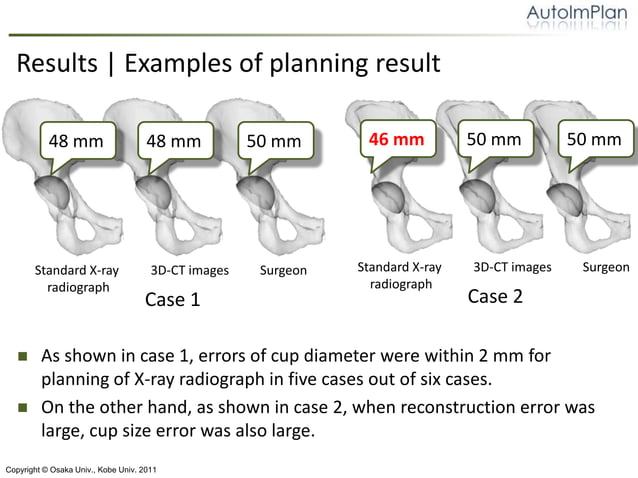 An automated 3D cup planning in total hip arthroplasty from a standard ...