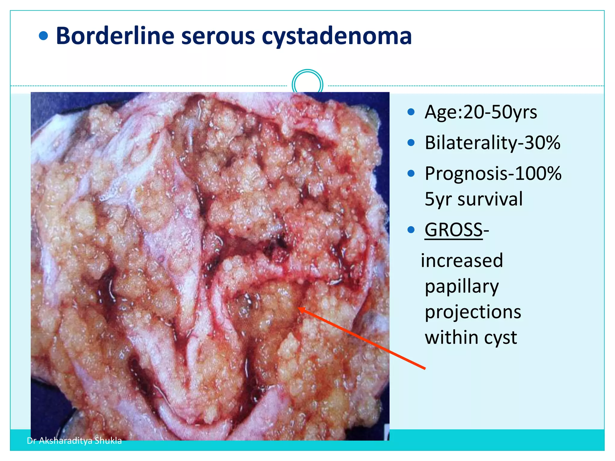 Ca ovary staging(AJCC 8th Edition& FIGO 2014) and classification | PPTX