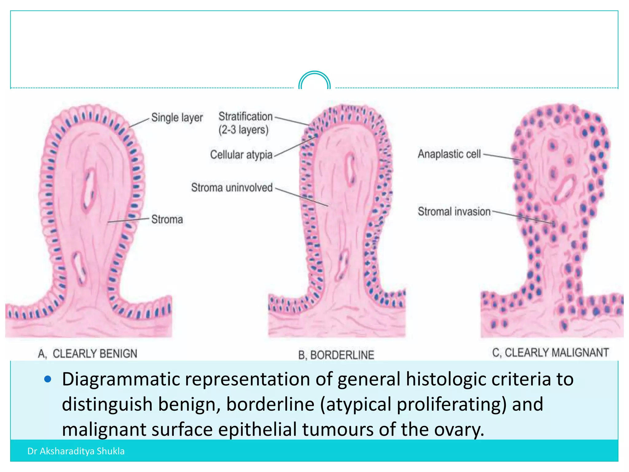 Ca ovary staging(AJCC 8th Edition& FIGO 2014) and classification | PPTX
