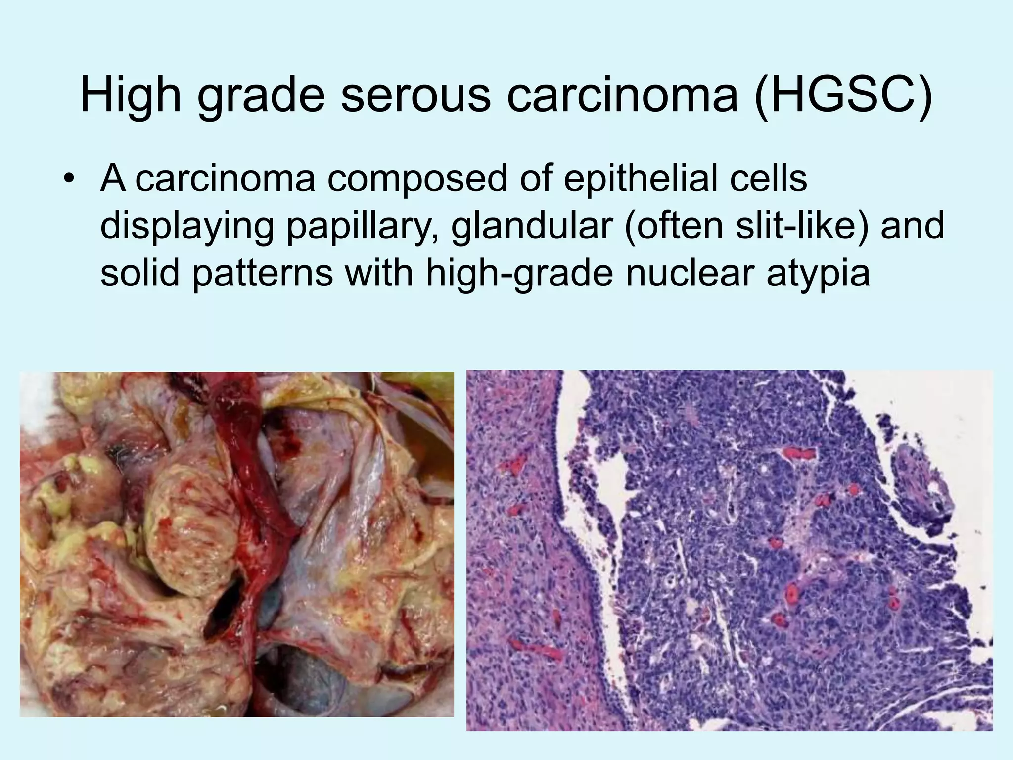 Ca ovary staging(AJCC 8th Edition& FIGO 2014) and classification | PPTX