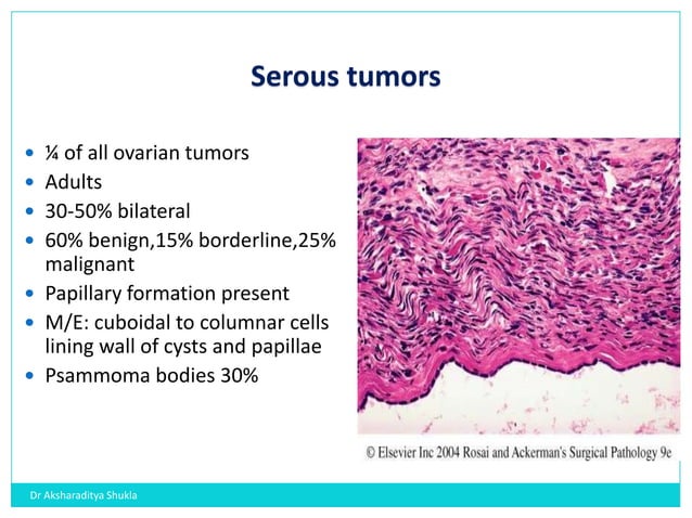 Ca ovary staging(AJCC 8th Edition& FIGO 2014) and classification | PPTX ...