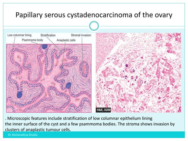 Ca ovary staging(AJCC 8th Edition& FIGO 2014) and classification | PPTX ...