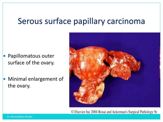 Ca ovary staging(AJCC 8th Edition& FIGO 2014) and classification | PPTX ...