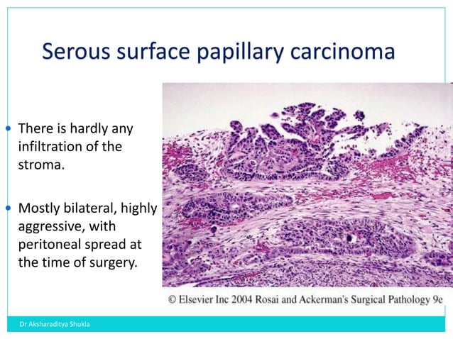 Ca ovary staging(AJCC 8th Edition& FIGO 2014) and classification | PPTX ...