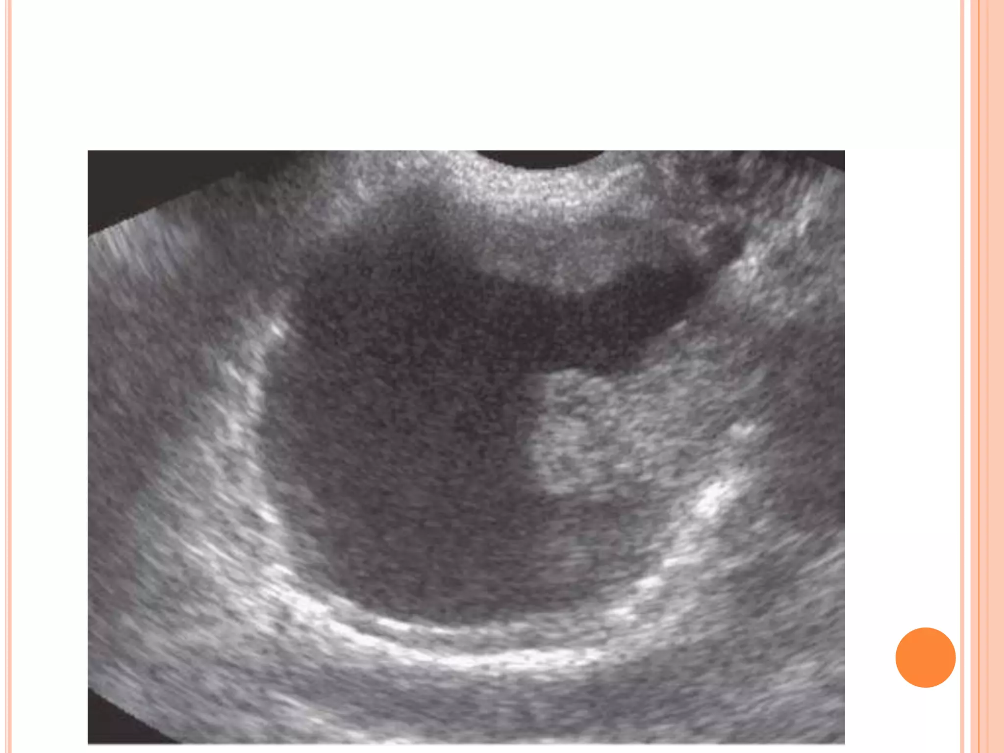 Ca ovary staging etiology pathogenesis | PPTX