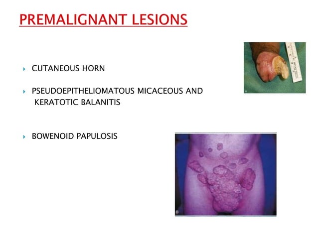 CARCINOMA PENIS | PPTX