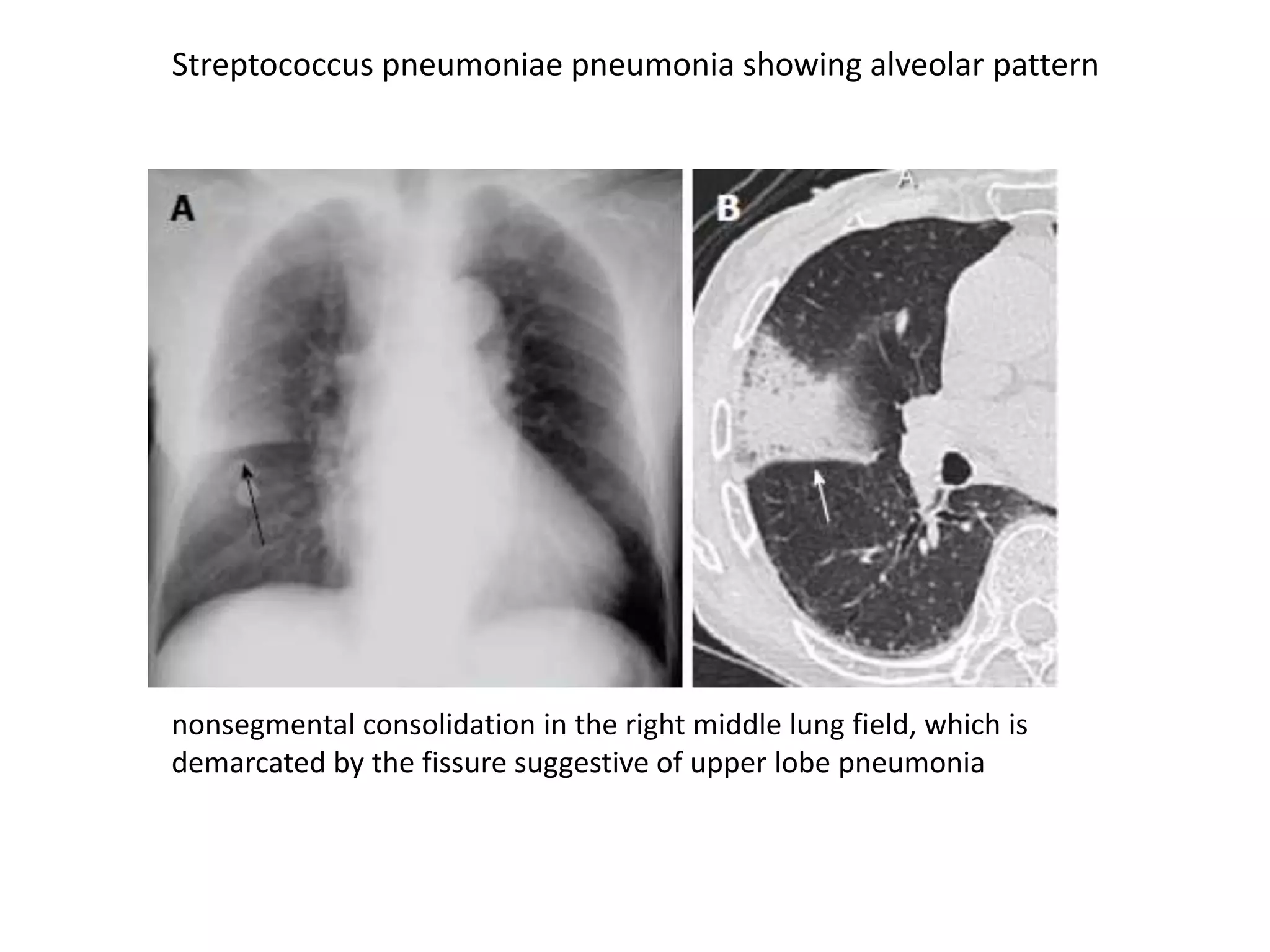 Community Acquired Pneumonia | PPTX
