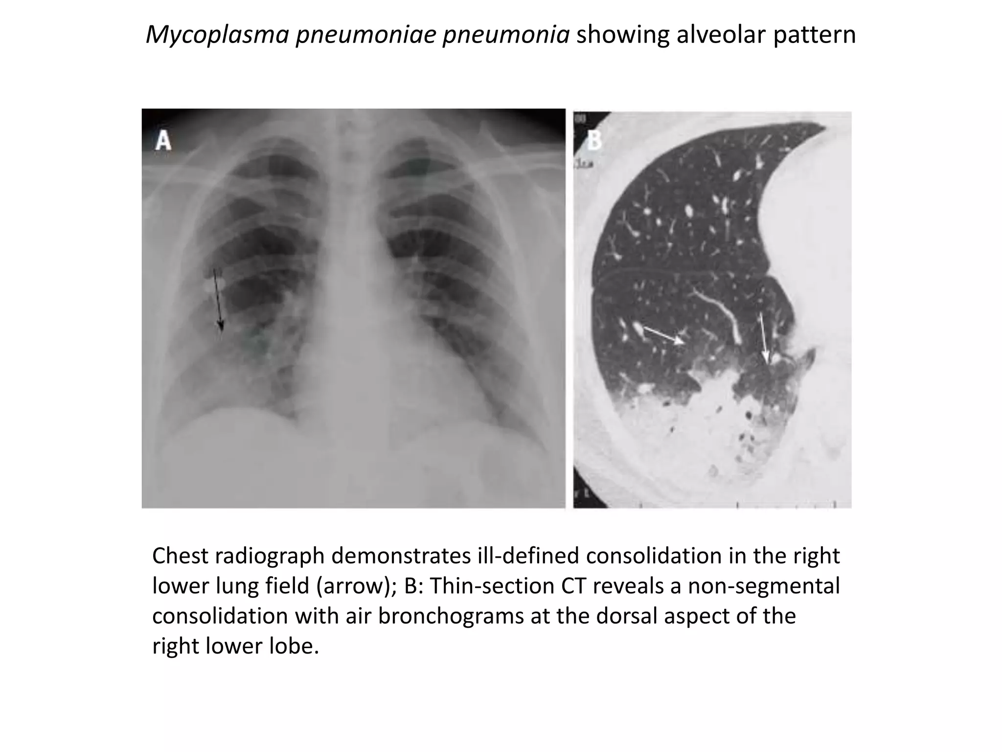 Community Acquired Pneumonia | PPTX