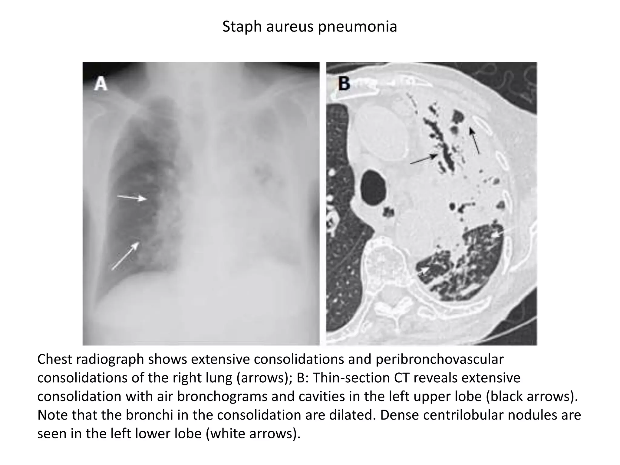 Community Acquired Pneumonia | PPTX