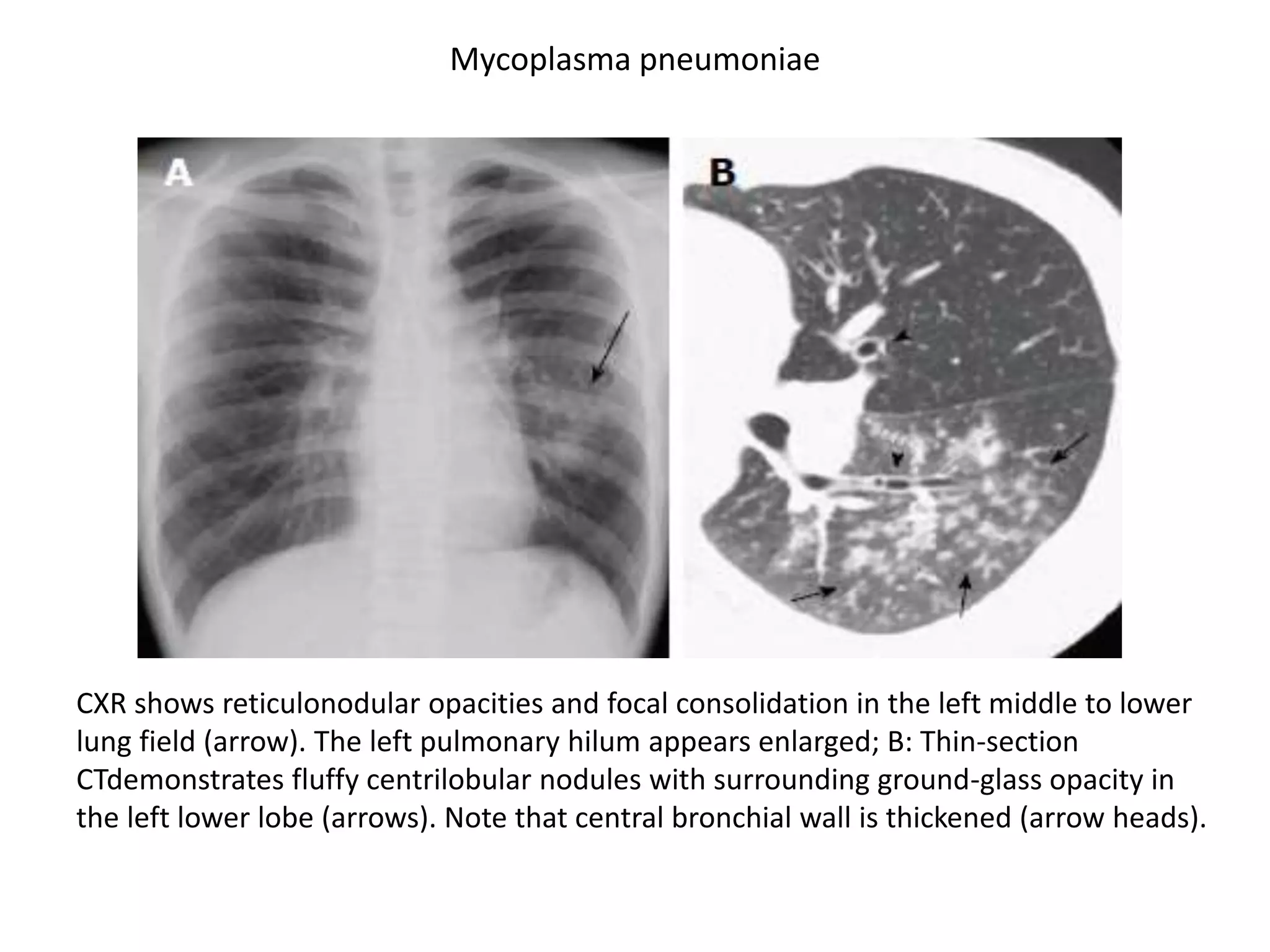 Community Acquired Pneumonia | PPTX