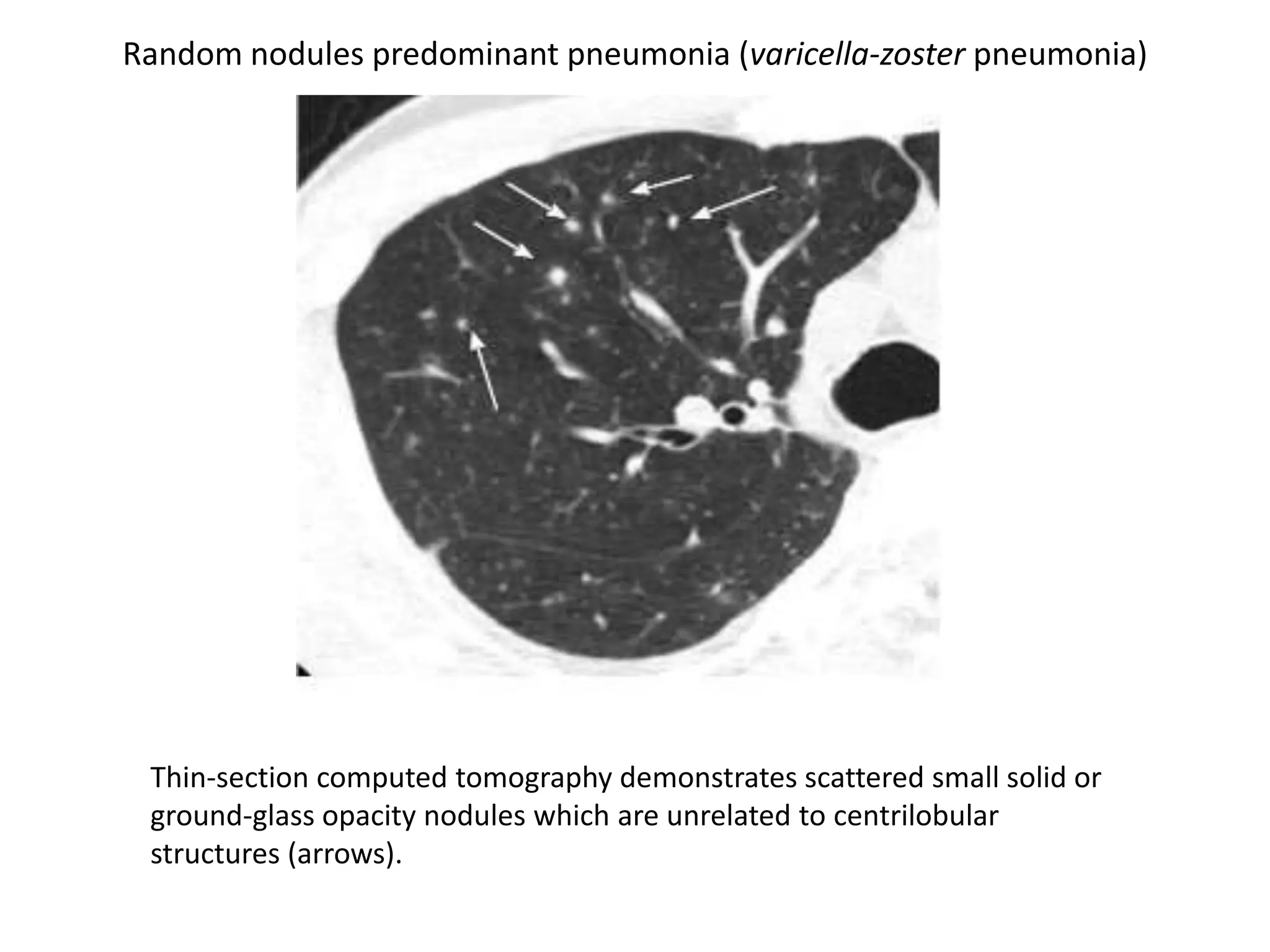 Community Acquired Pneumonia | PPTX