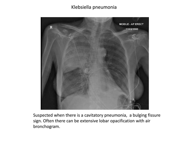 Community Acquired Pneumonia | PPTX | Infectious Diseases | Diseases ...