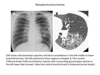Community Acquired Pneumonia | PPTX