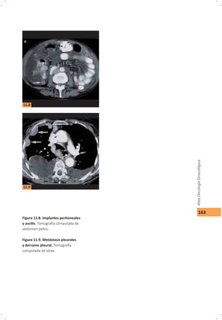 Cáncer primario de peritoneo | PDF