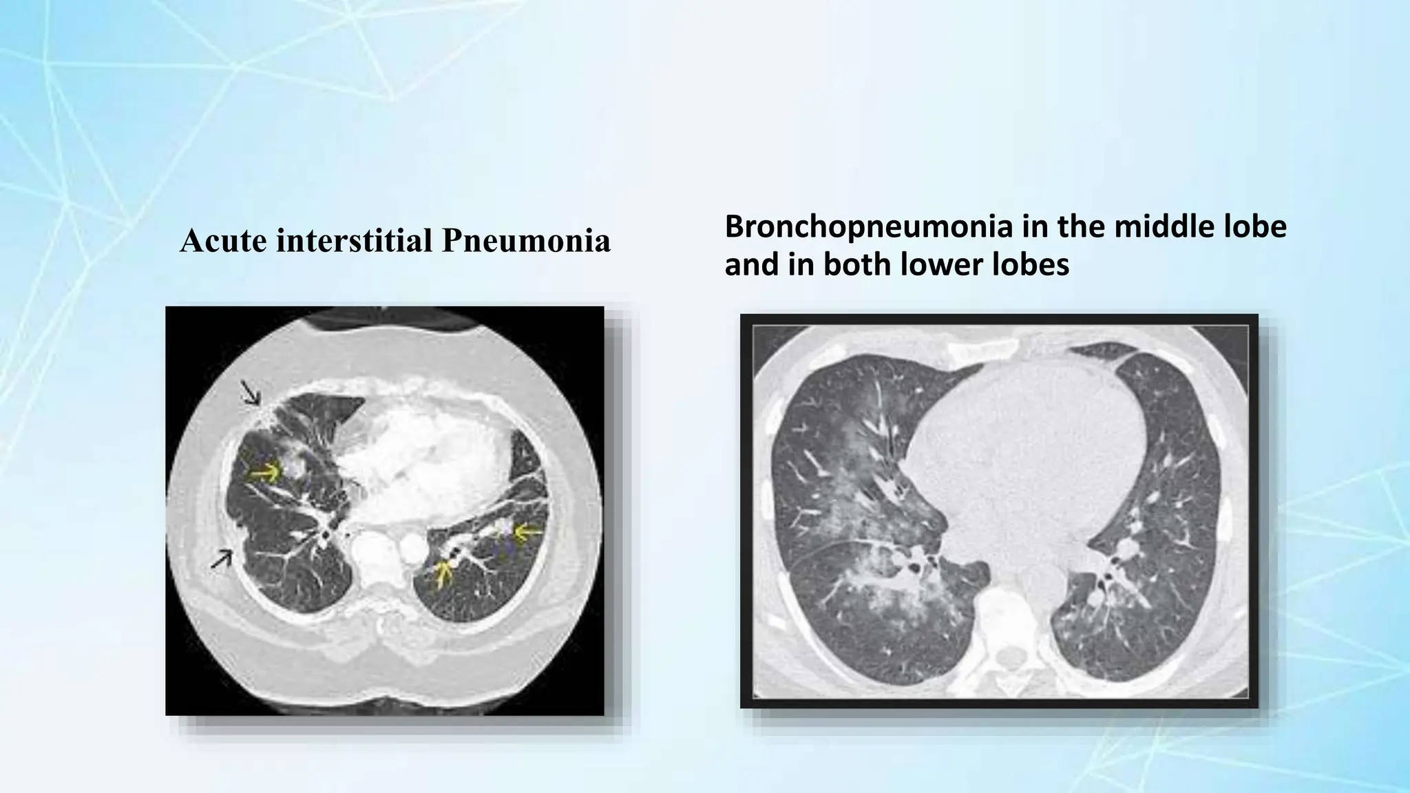 Community Acquired Pneumonia.pptx
