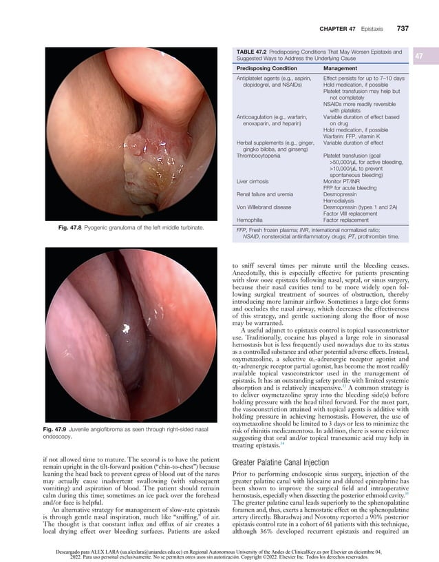 CAP 47. Epistaxis.pdf