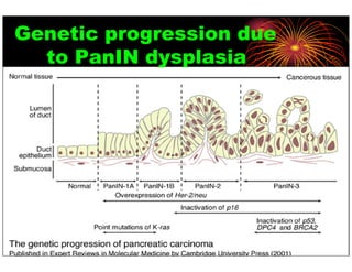 Pancreatic Carcinoma | PDF