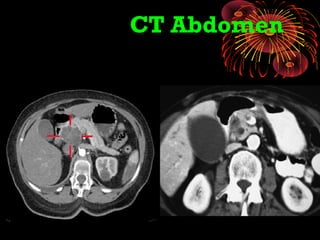 PANCREATIC CARCINOMA/ Obstructive Jaundice | PPT