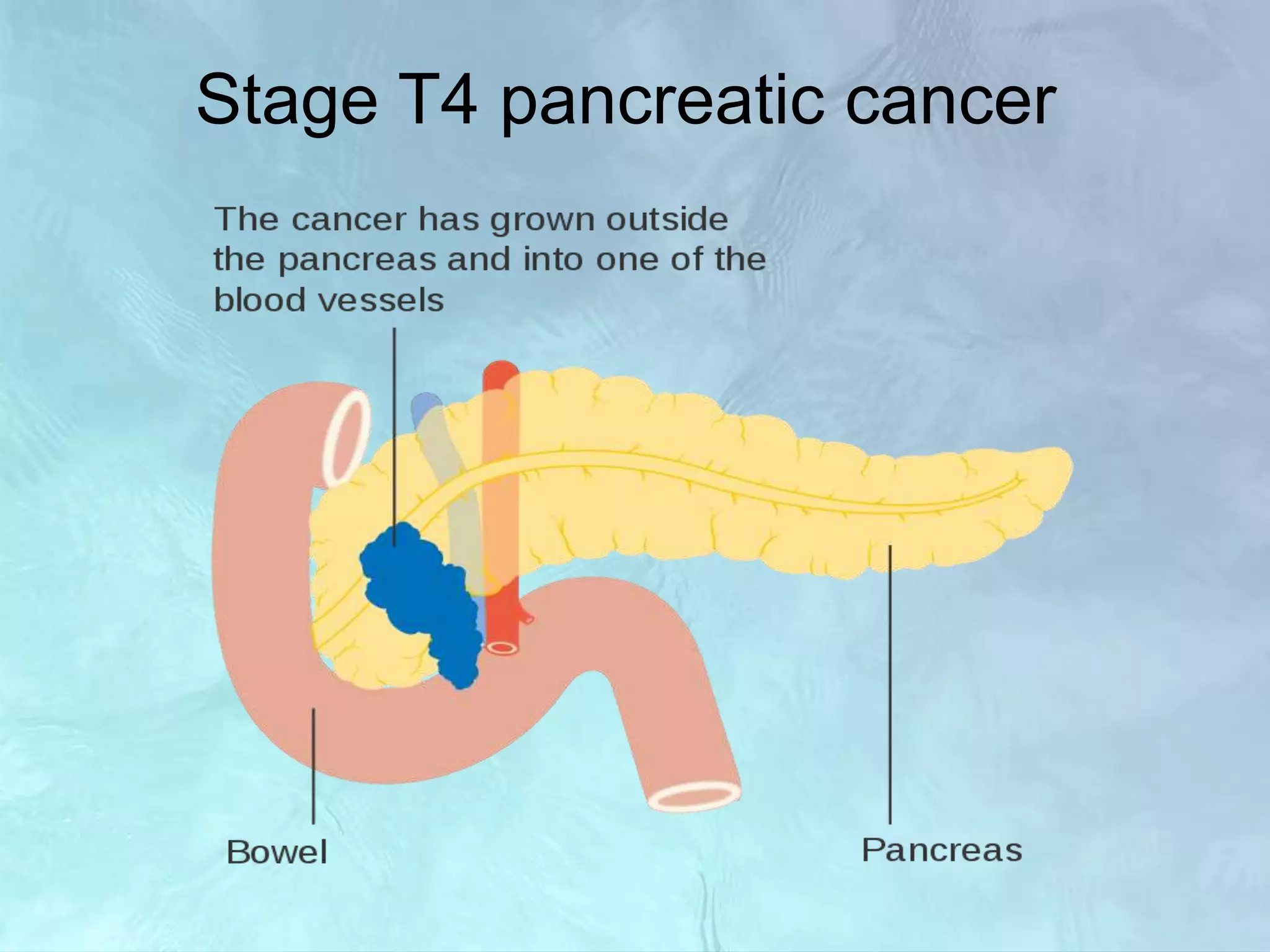 Ca pancreas [autosaved] | PPTX