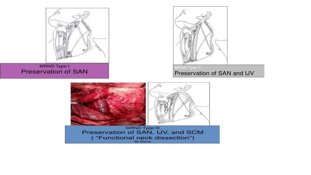 Ca Papillary Thyroid Gland Ppt