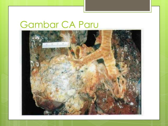 Cancer paru | PPT