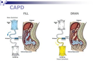CAPD.ppt