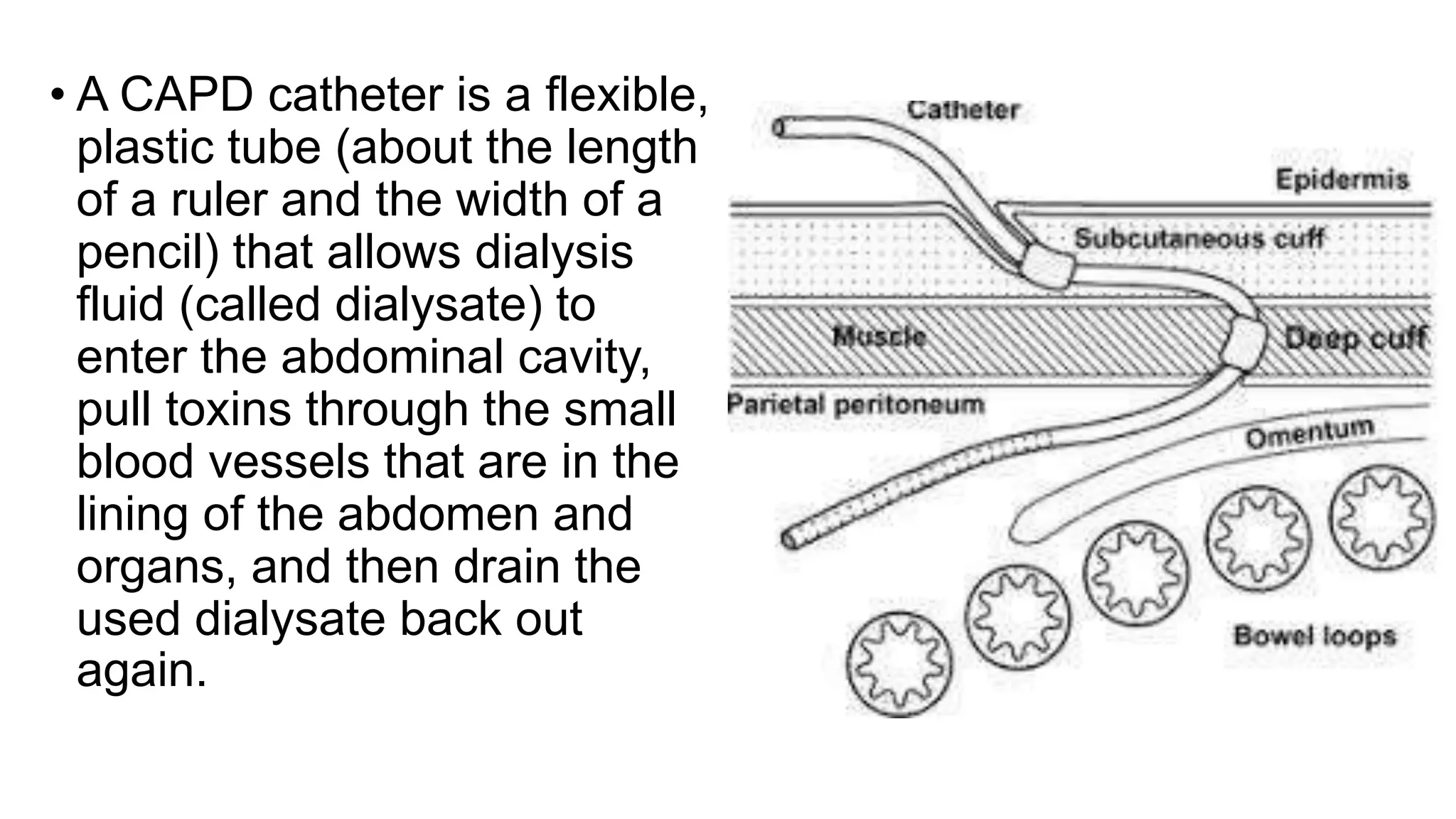 CAPD Catheters.pptx