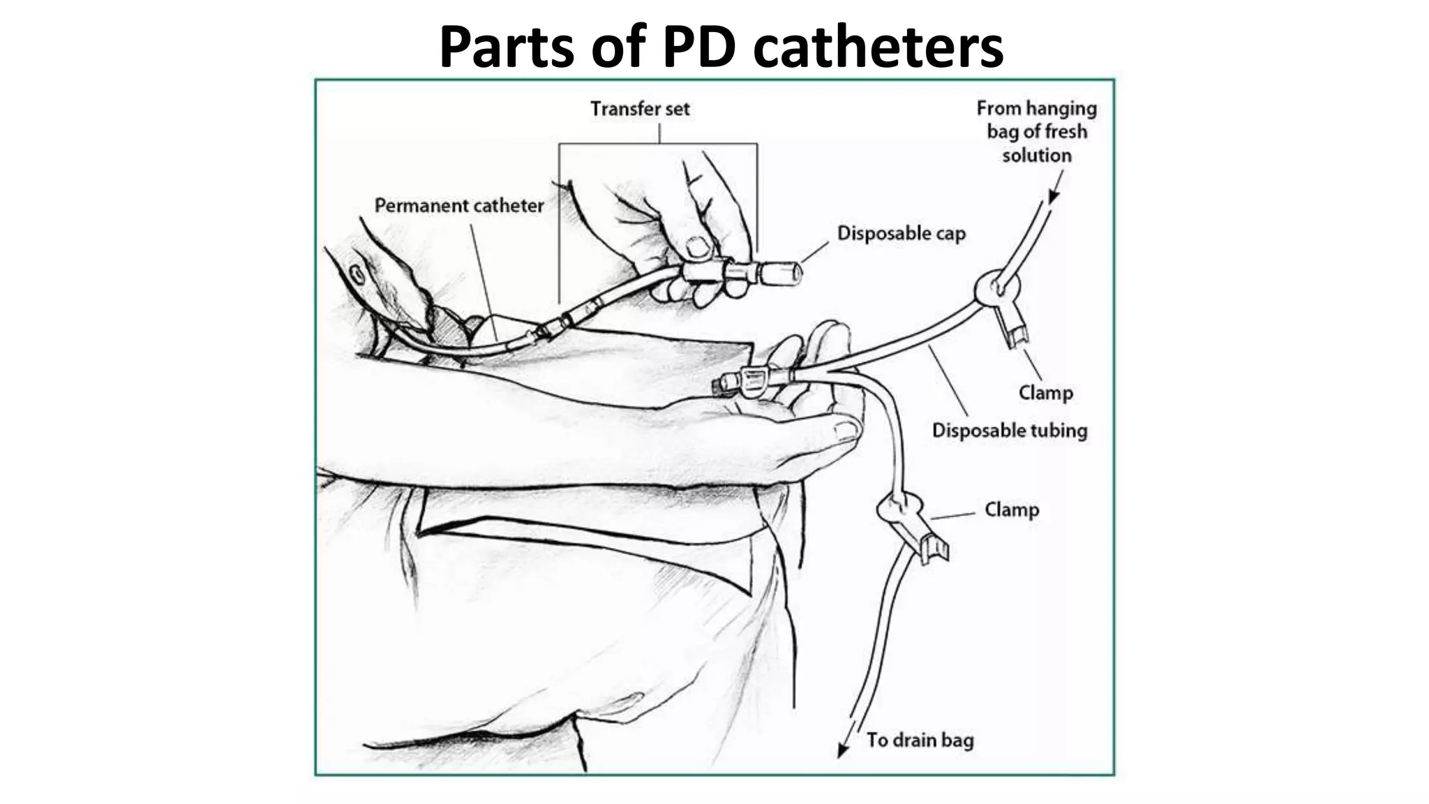 CAPD Catheters.pptx