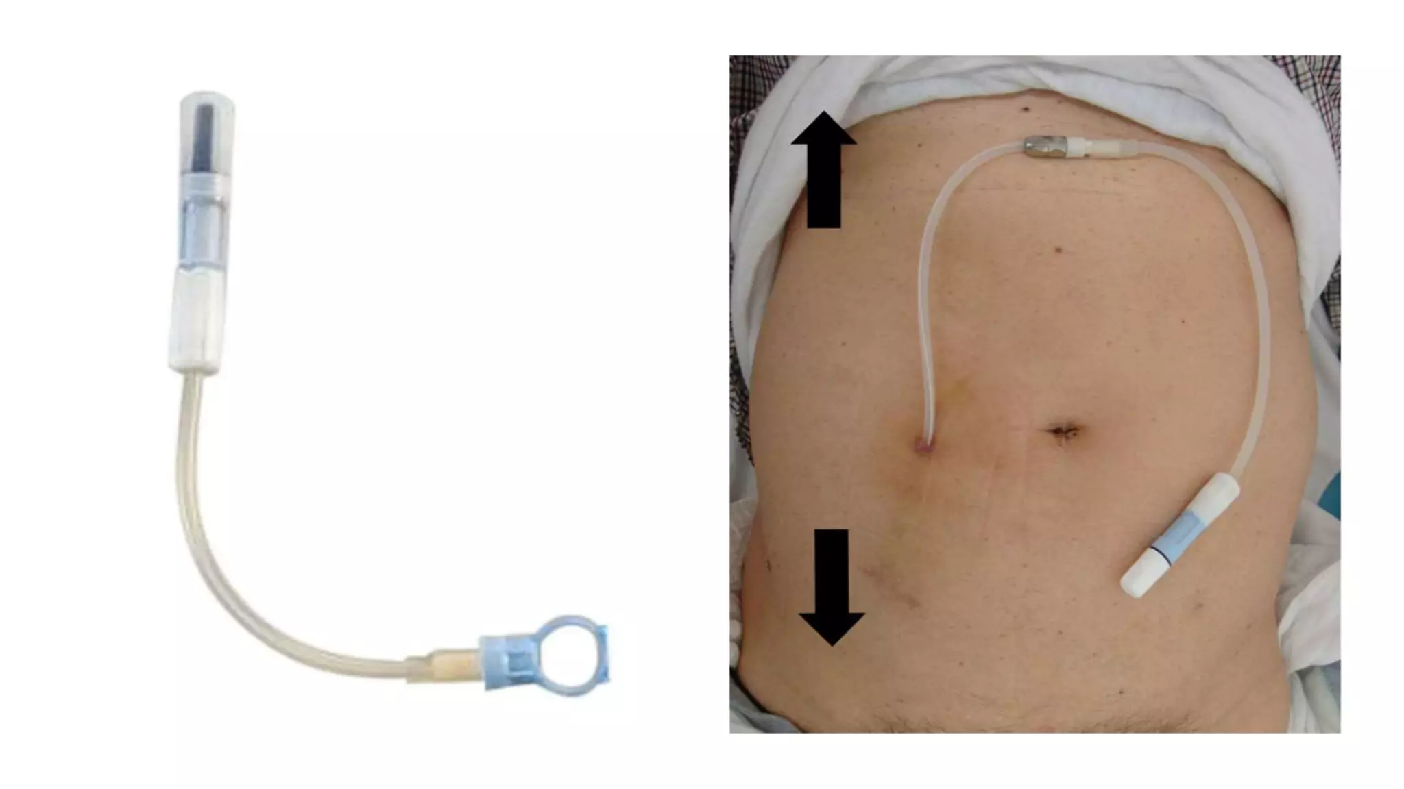 CAPD Catheters.pptx